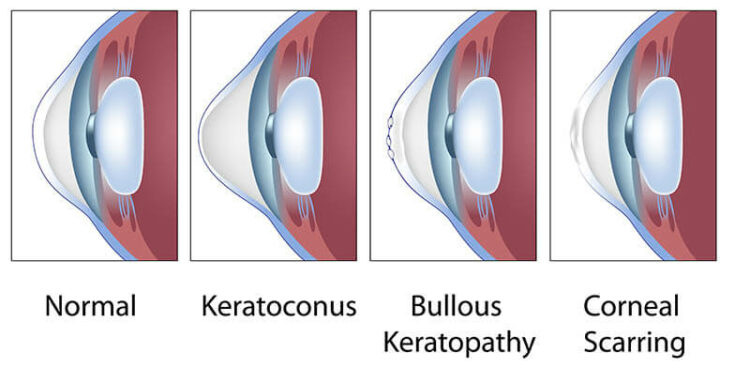 Cornea Specialist Jacksonville | Corneal Conditions Jacksonville